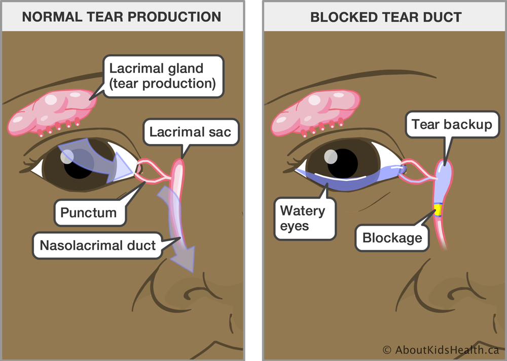 Clear Blocked Tear Duct Naturally